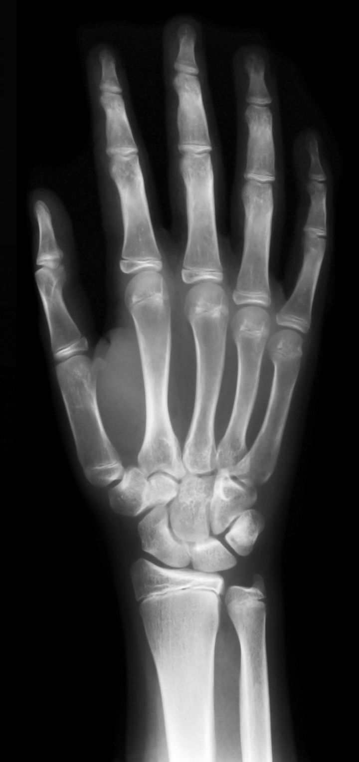 On The Topic of Flexor Tendon Problems - Toby Orthopaedics